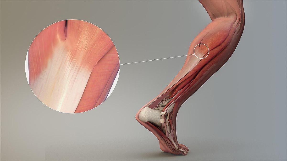 Tendon Nedir, Ne İşe Yarar? Tendon Yırtığı, Kopması, Sıkışması Nasıl ...